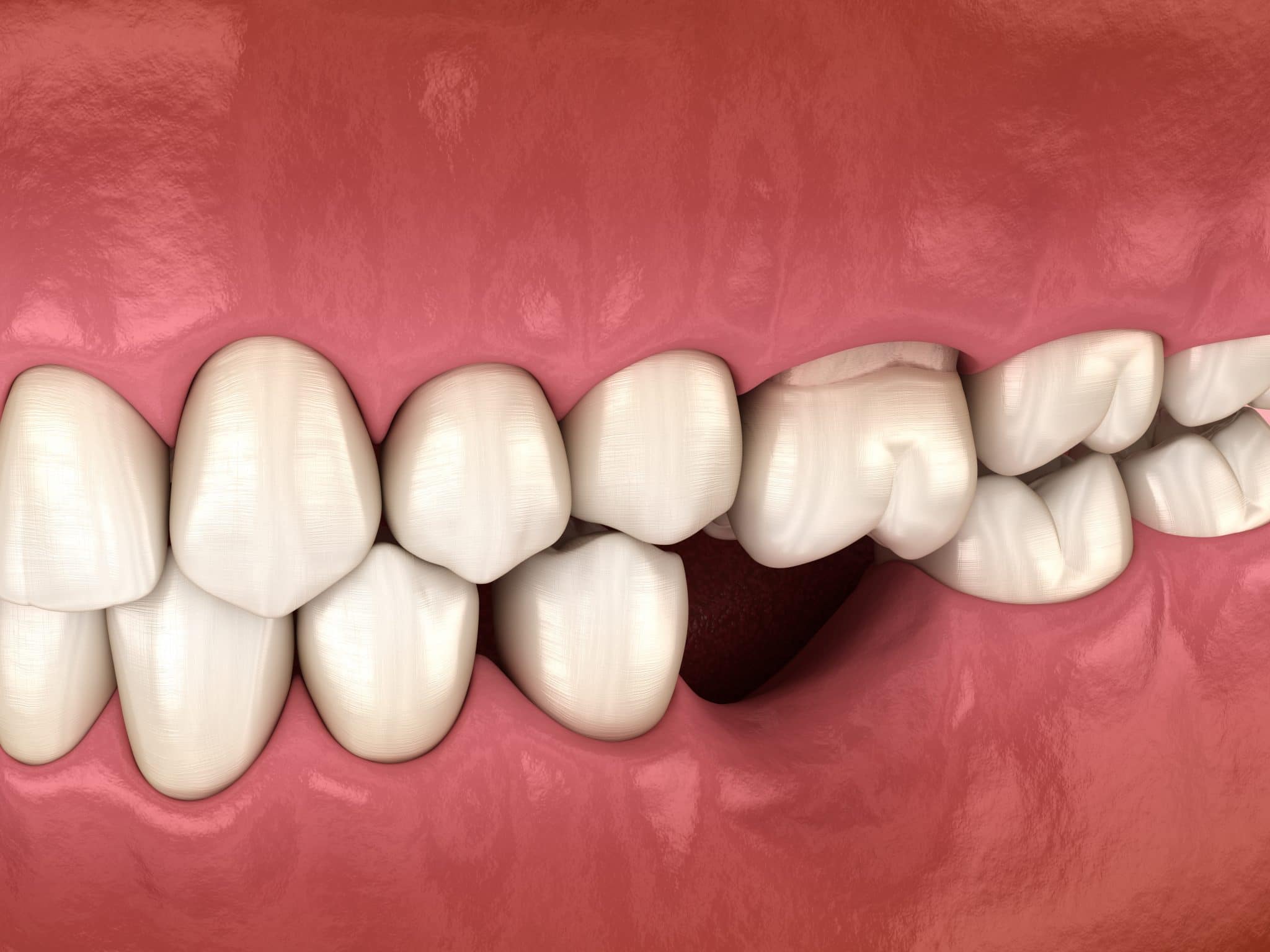 Livonia Dentist Explains What Happens When We Lose A Tooth | Dr. James ...