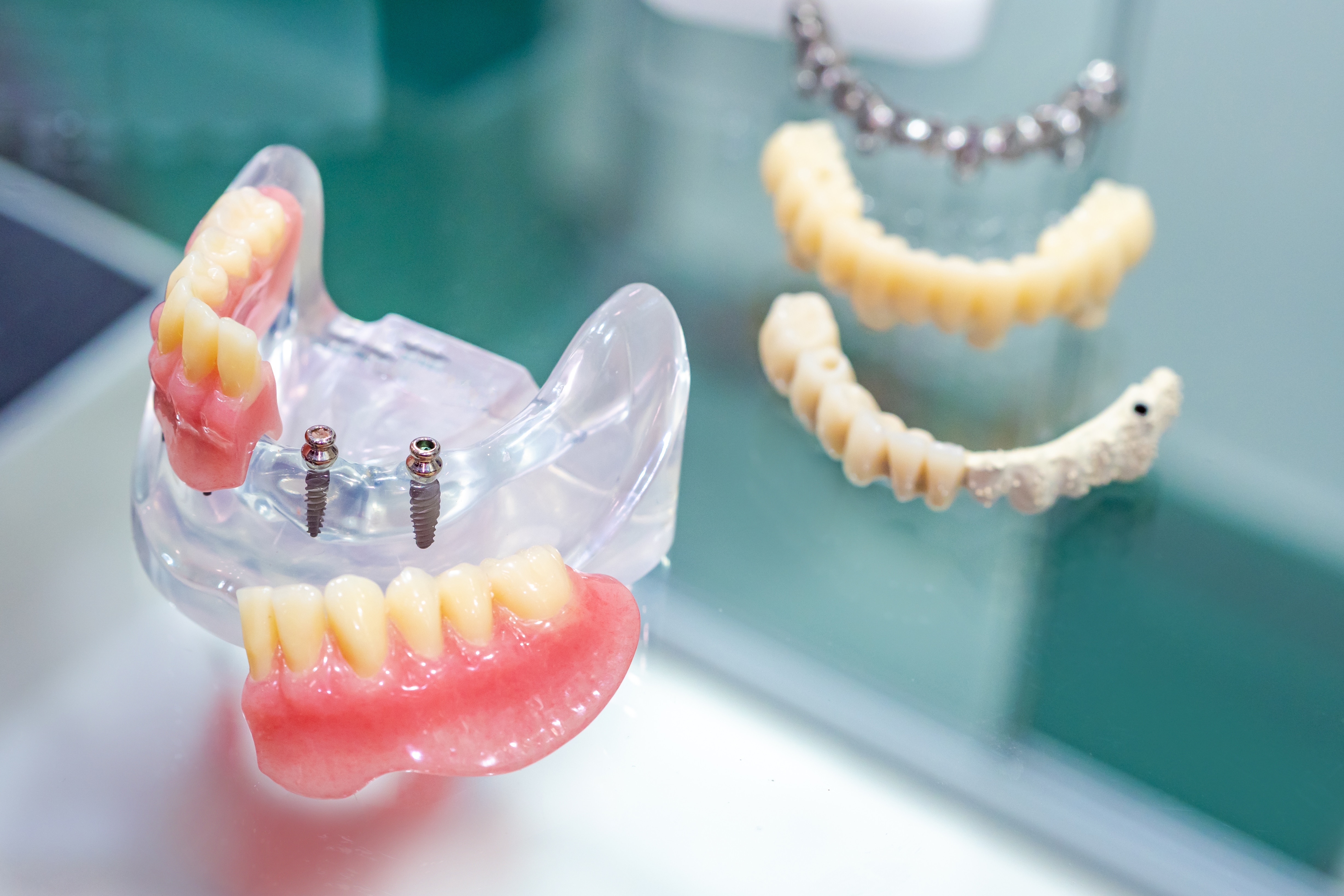Livonia Dentist Explains How Your Smile May Benefit From Mini Implants ...