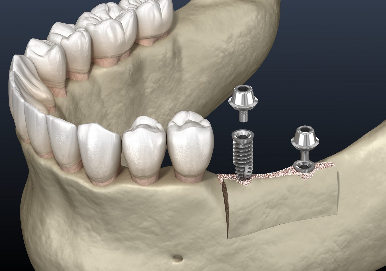Could A Weak Jaw Support Mini Implants? | Livonia, MI