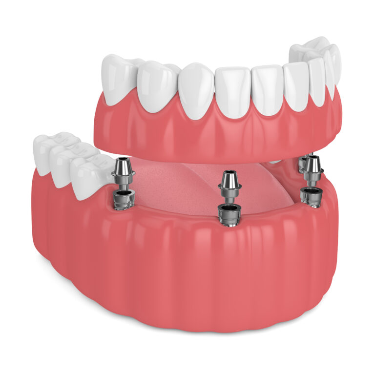 How Do Dental Implants Secure A Partial? | Livonia, MI