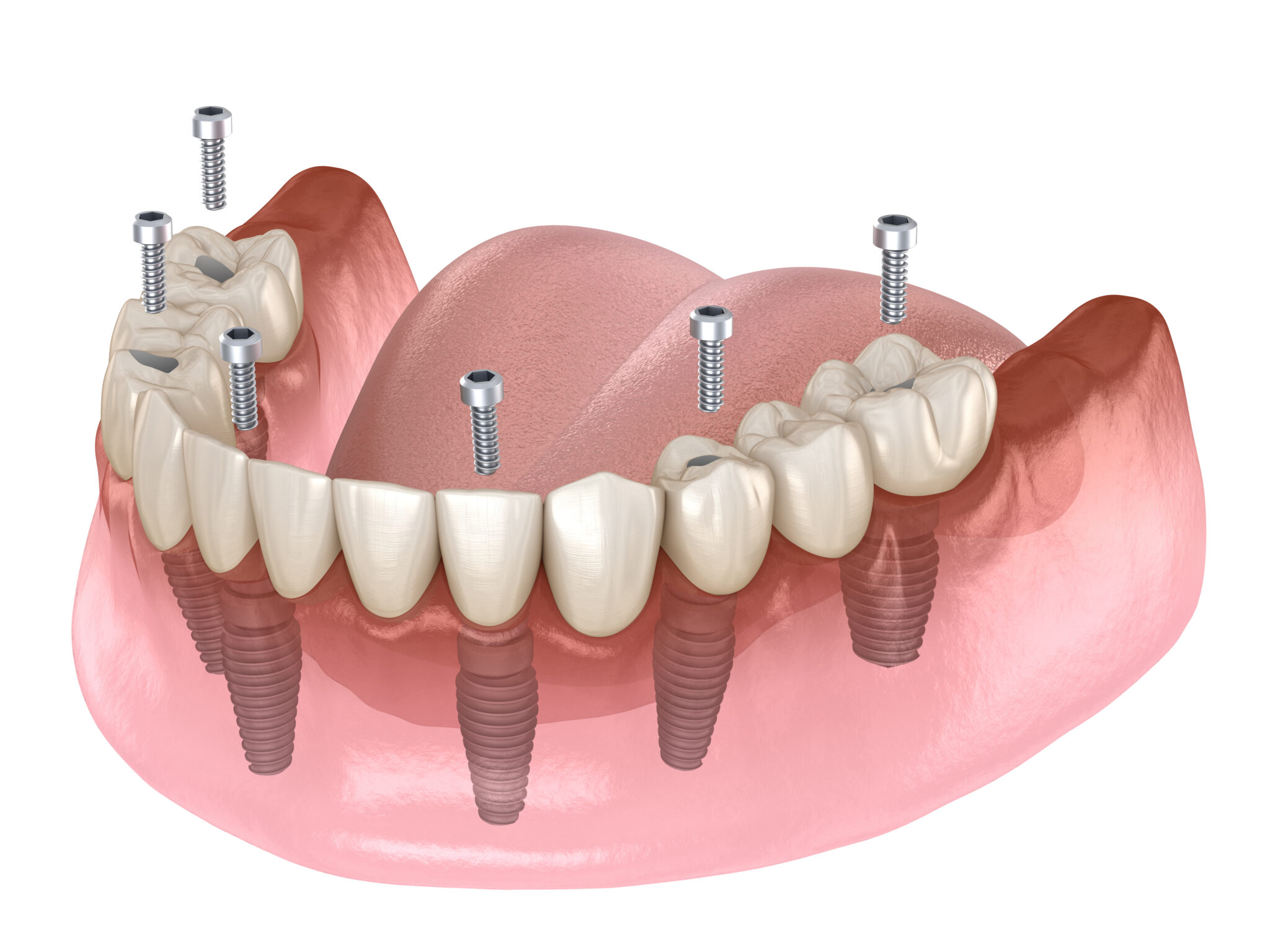 Strong And Lifelike Dentures With Implants | Livonia, MI