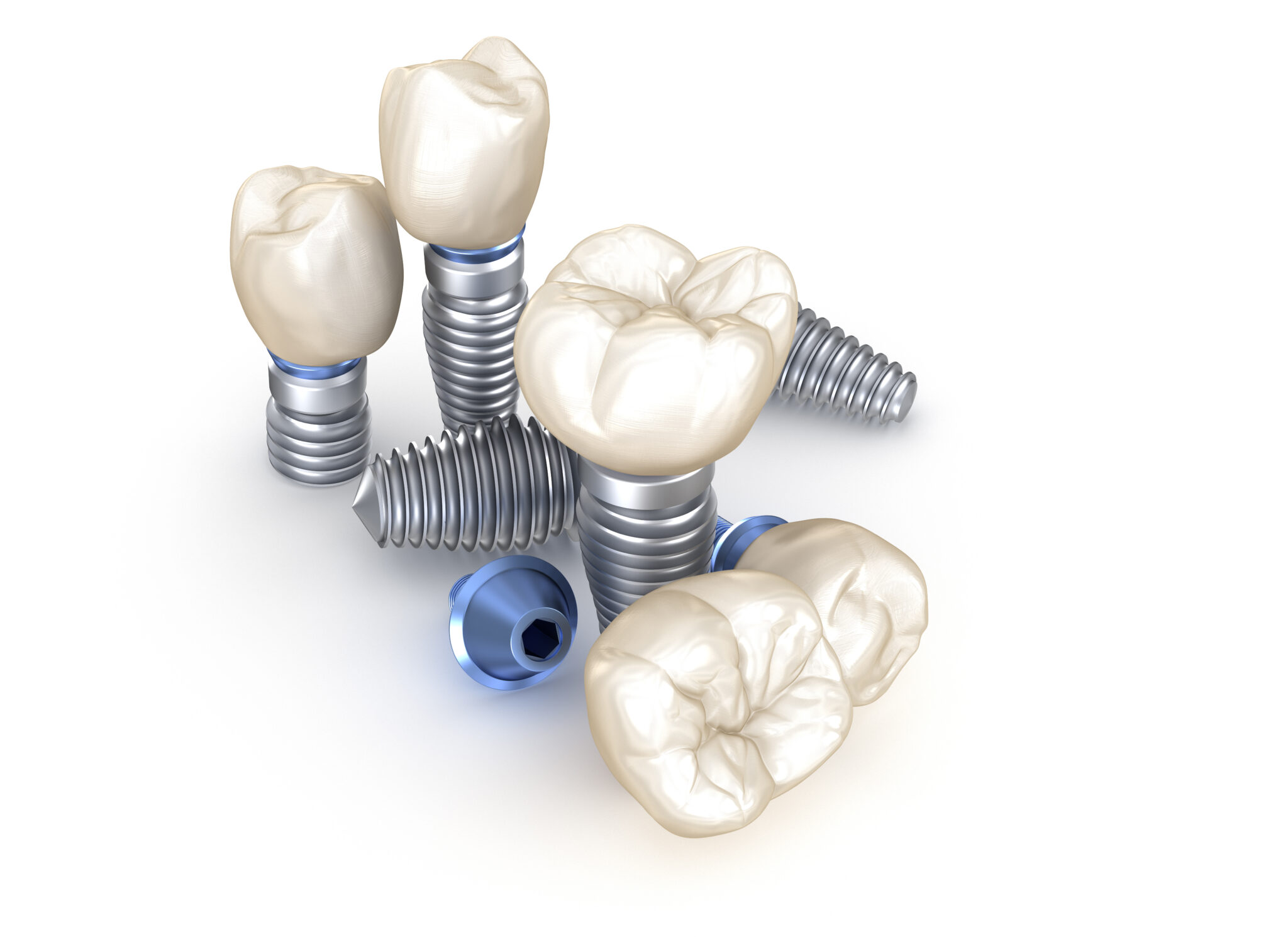 Could Your Smile Use Mini Implants Livonia Mi